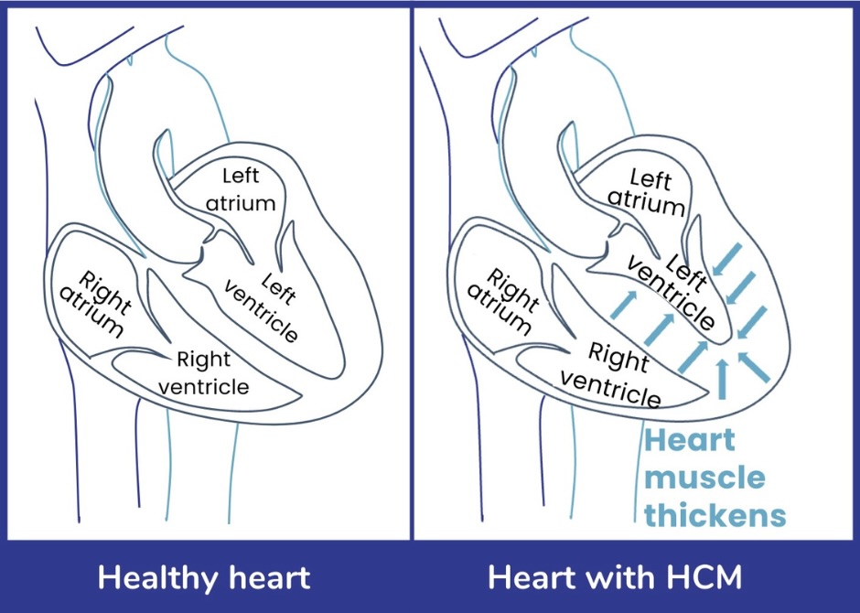 Hypertrophic Cardiomyopathy - NSW Hearts